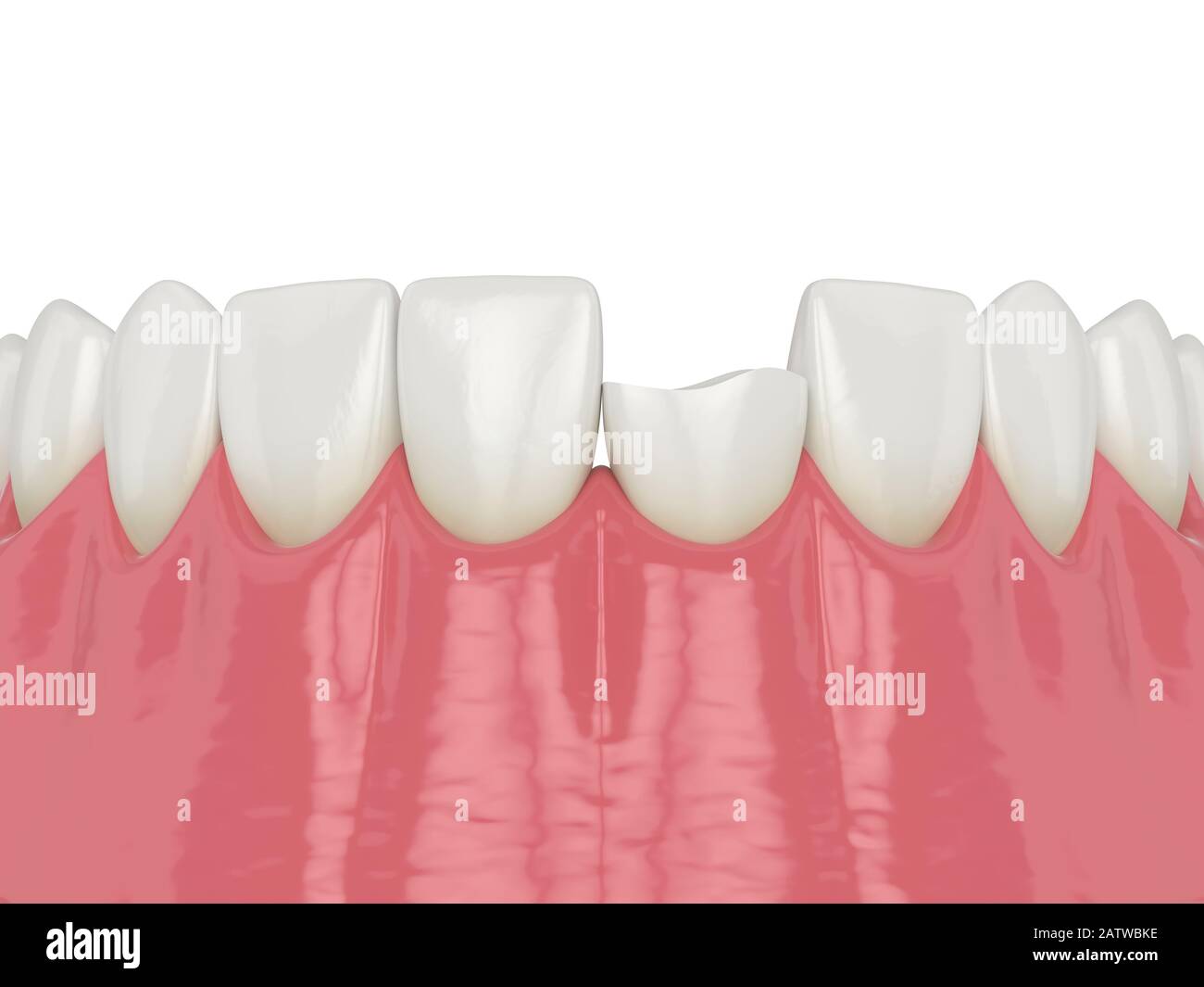 3d render of lower jaw with broken incisor tooth over white background ...