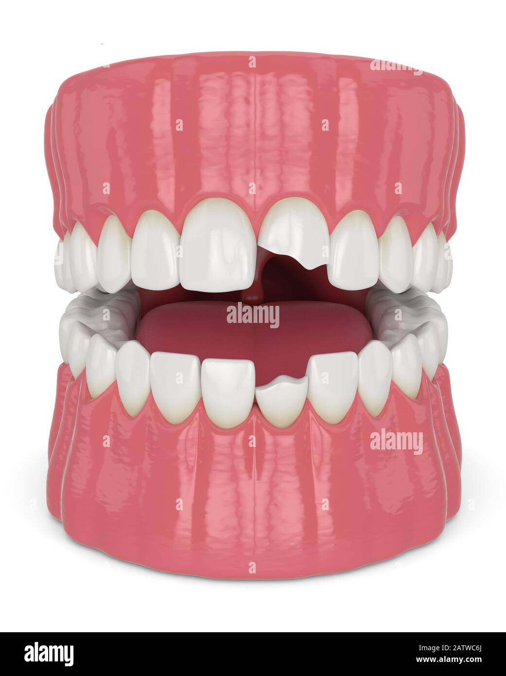 Chipped teeth hi-res stock photography and images - Alamy