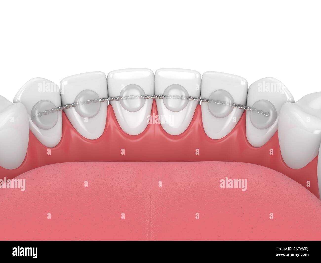 3d render of dental bonded retainer on lower jaw over white background ...