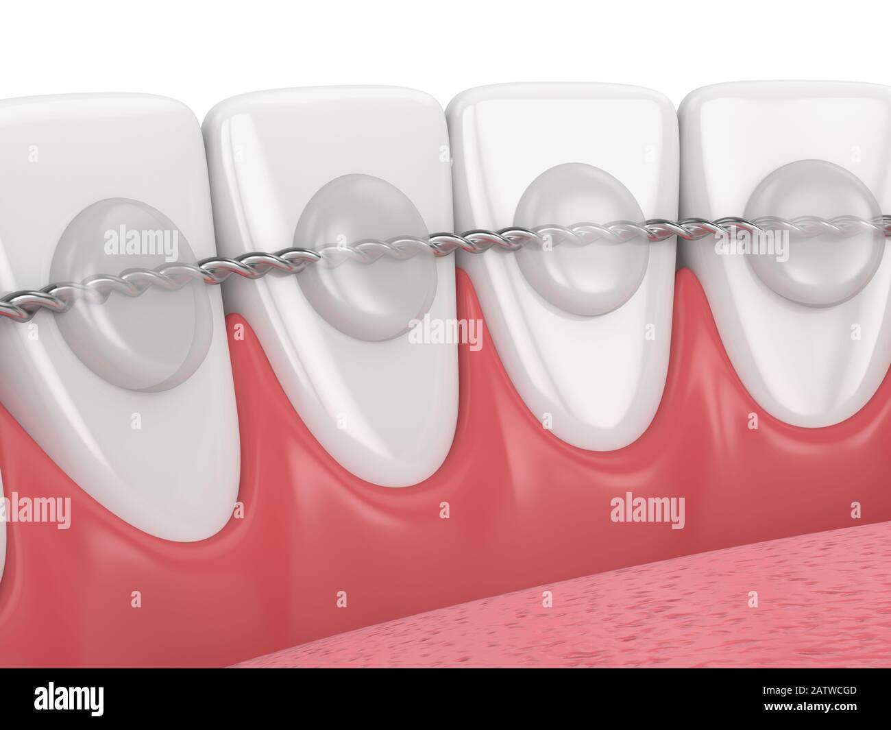 3d render of dental bonded retainer on lower jaw over white background ...