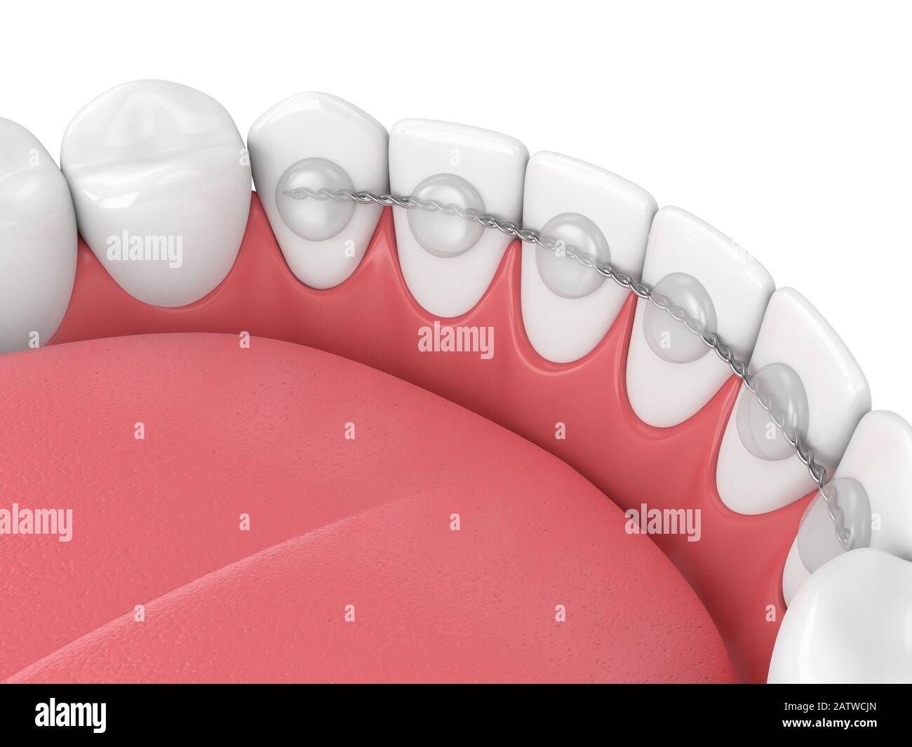 3d render of dental bonded retainer on lower jaw over white background ...