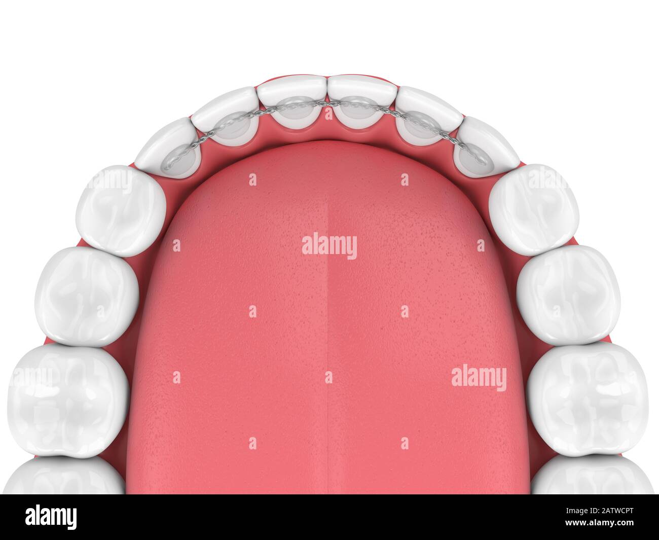 3d render of dental bonded retainer on lower jaw over white background ...