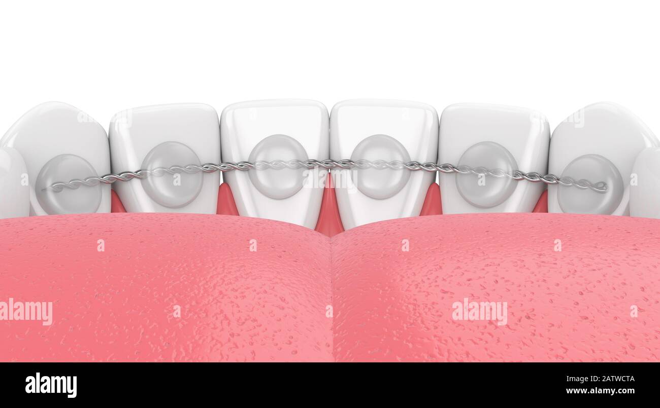 3d render of dental bonded retainer on lower jaw over white background ...