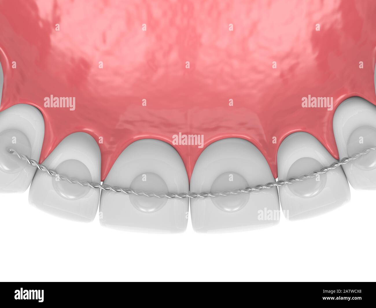 3d render of dental bonded retainer on upper jaw over white background ...