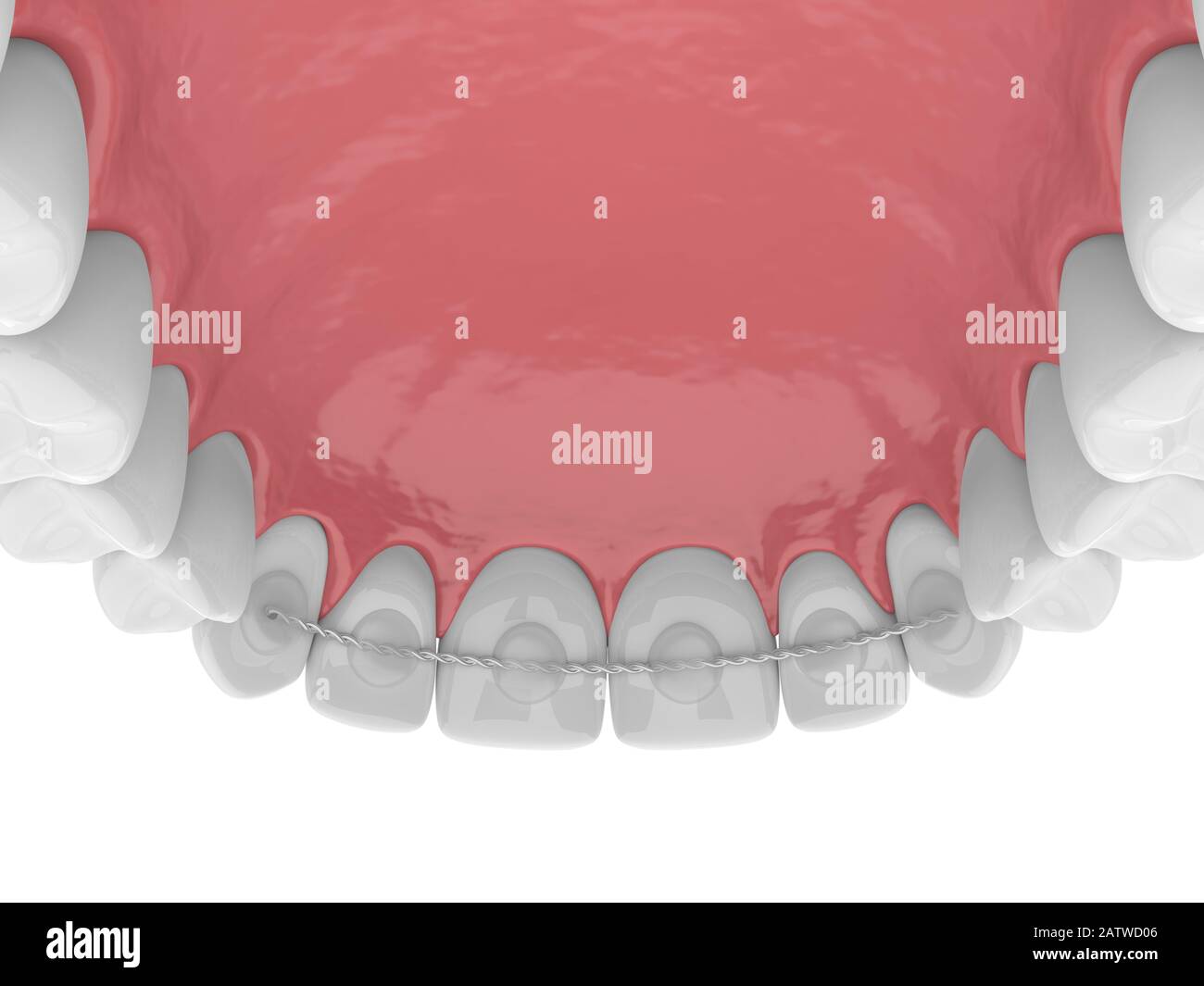 3d render of dental bonded retainer on upper jaw over white background ...