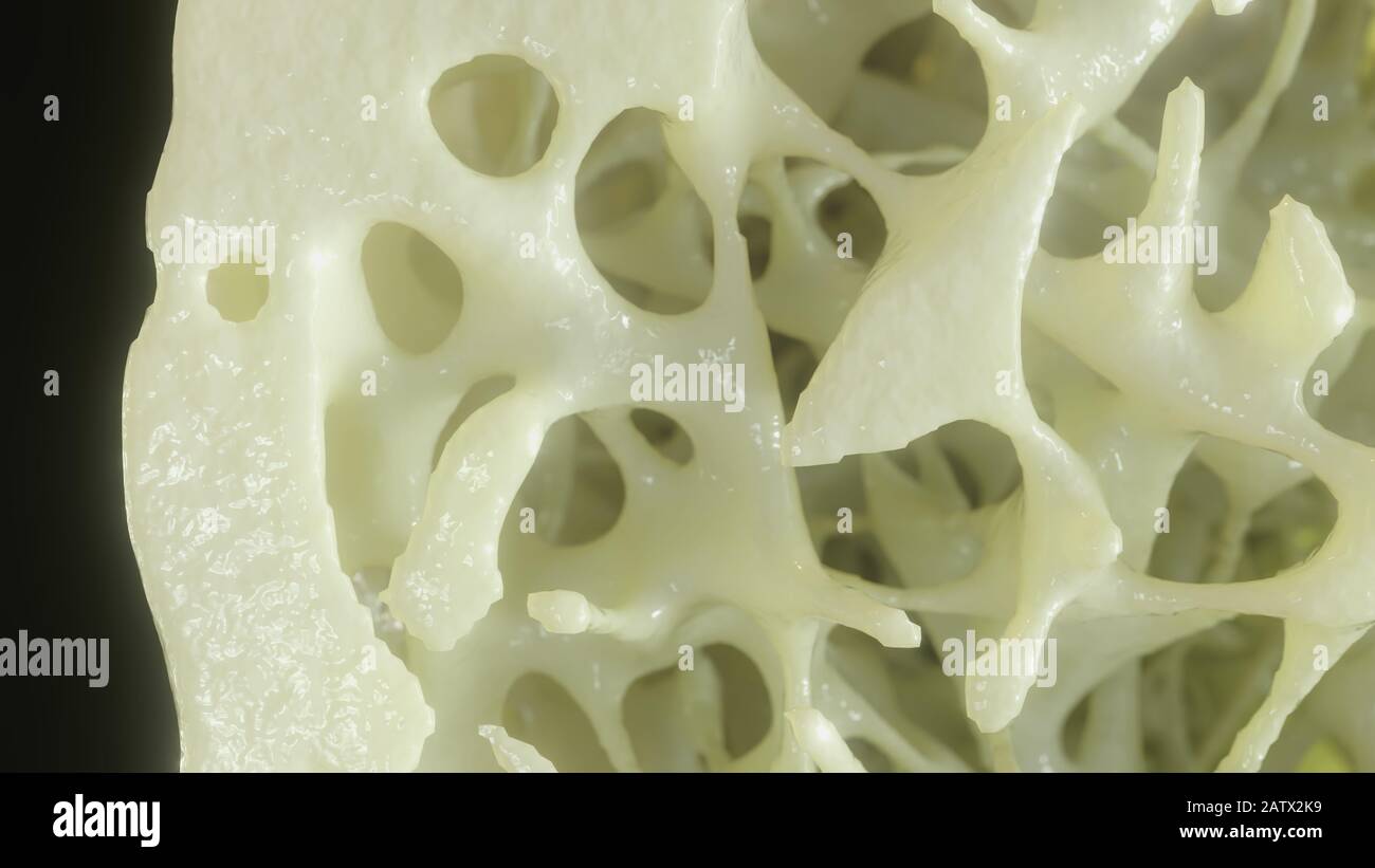Bone affected with osteoporosis - cross section - 3D rendering Stock ...