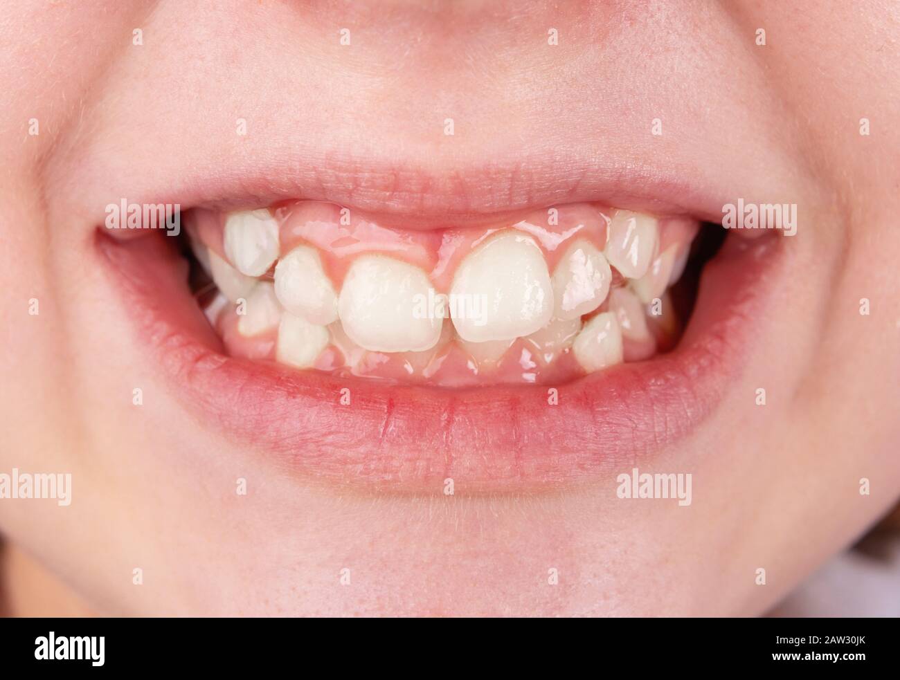 Closeup, frontal view on teenager mouth with permanent crooked teeth ...