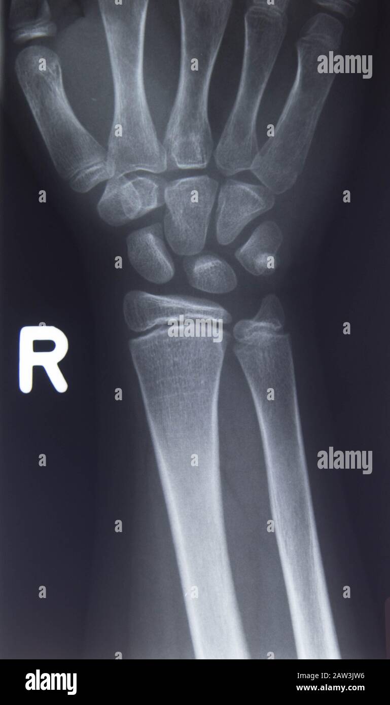 Roentgen x ray hi-res stock photography and images - Alamy