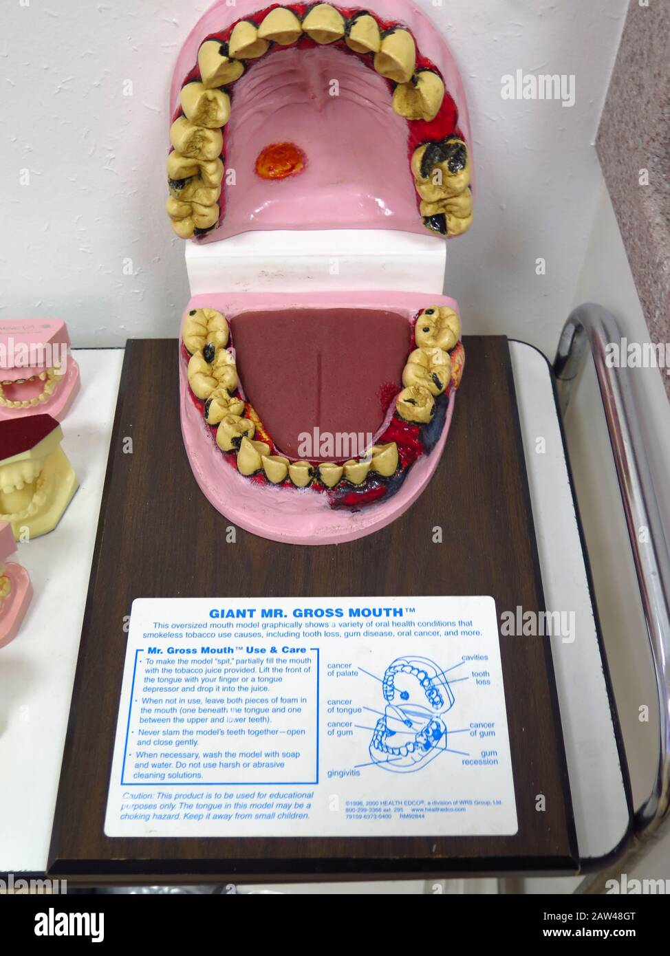 Gross Mouth model used by students showing common dental conditions ...