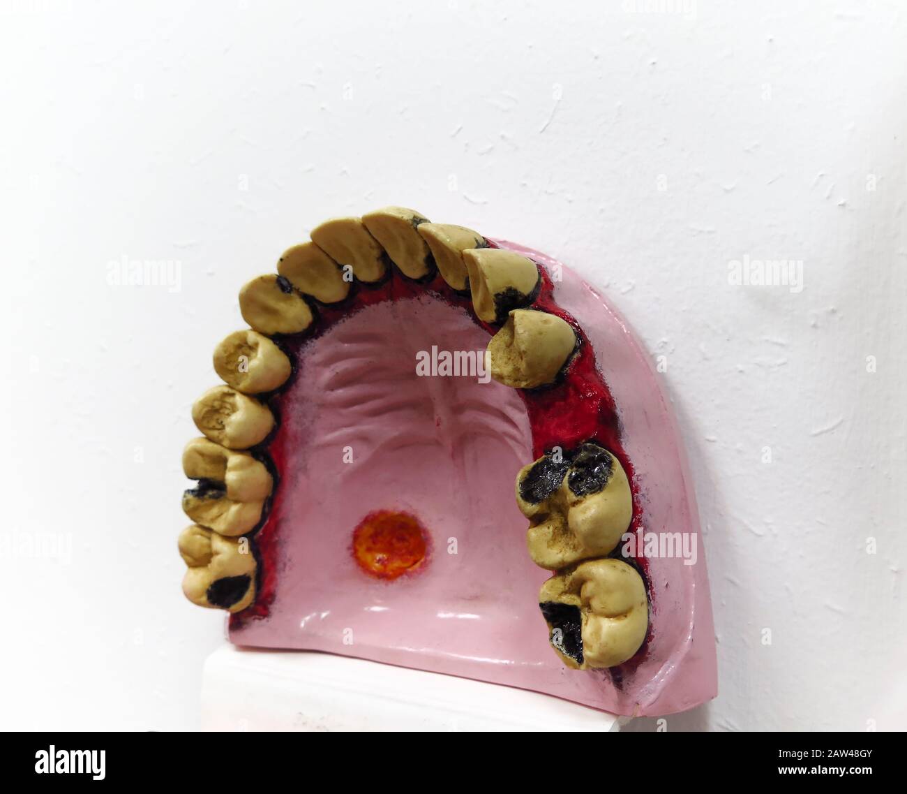 Gross Mouth model used by students showing common dental conditions ...