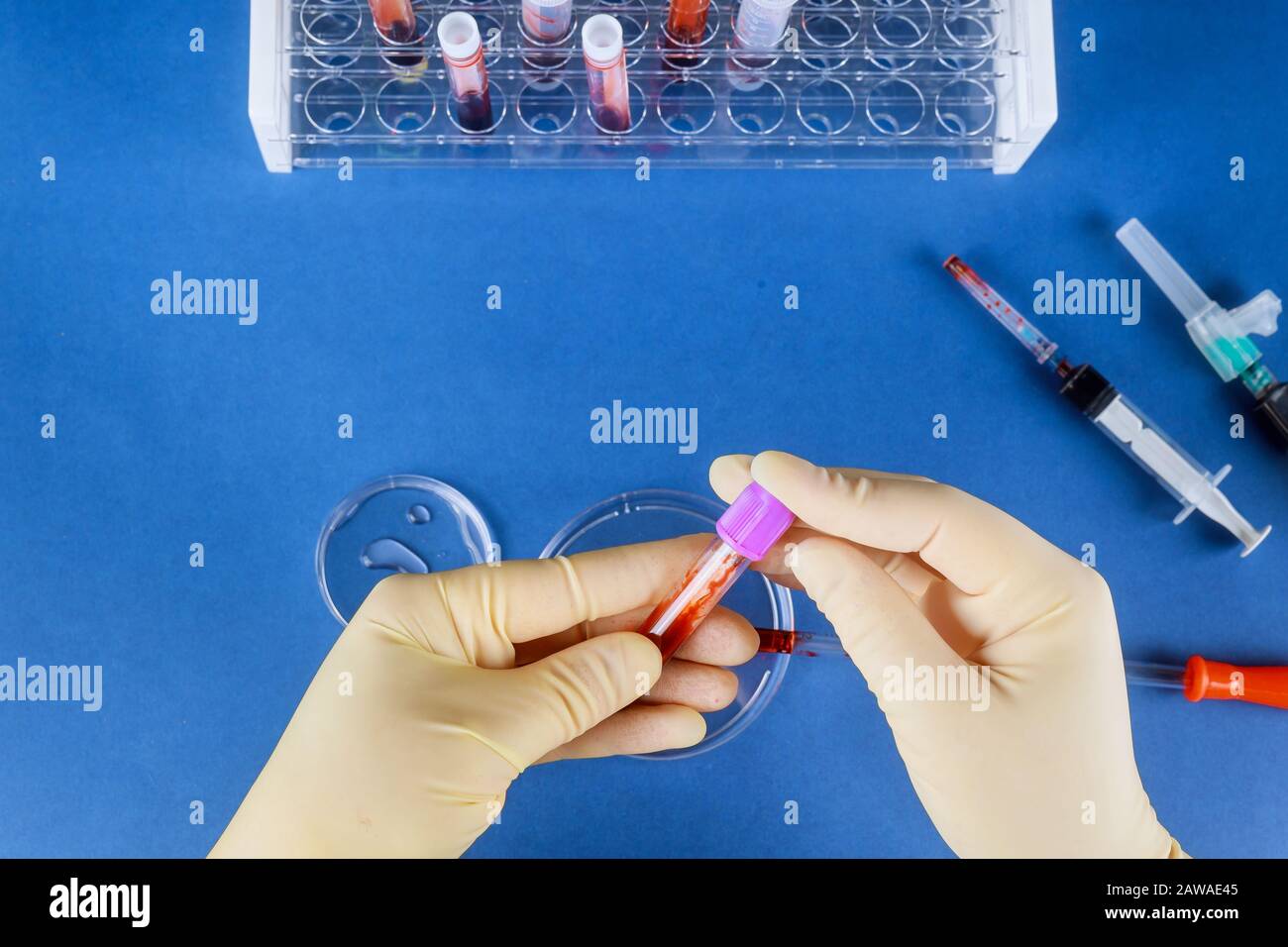 Hand holding blood sample vial in laboratory tube test Stock Photo - Alamy