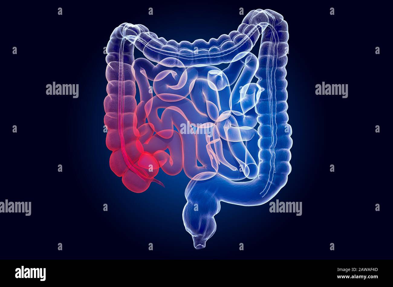 Pain in human intestines, bowel concept. Ghost light effect, x-ray ...