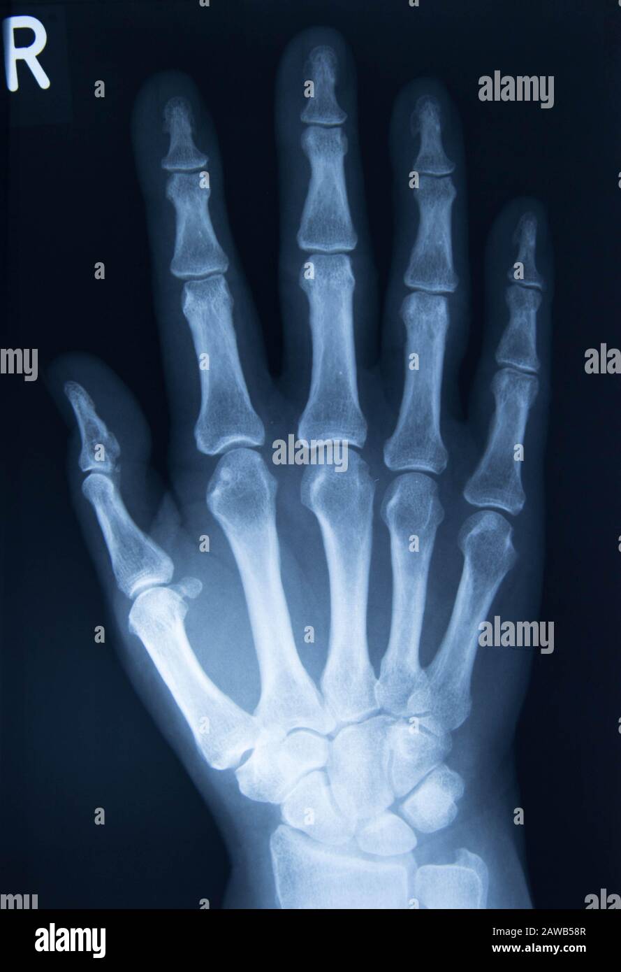 x-ray image hand and finger Stock Photo - Alamy