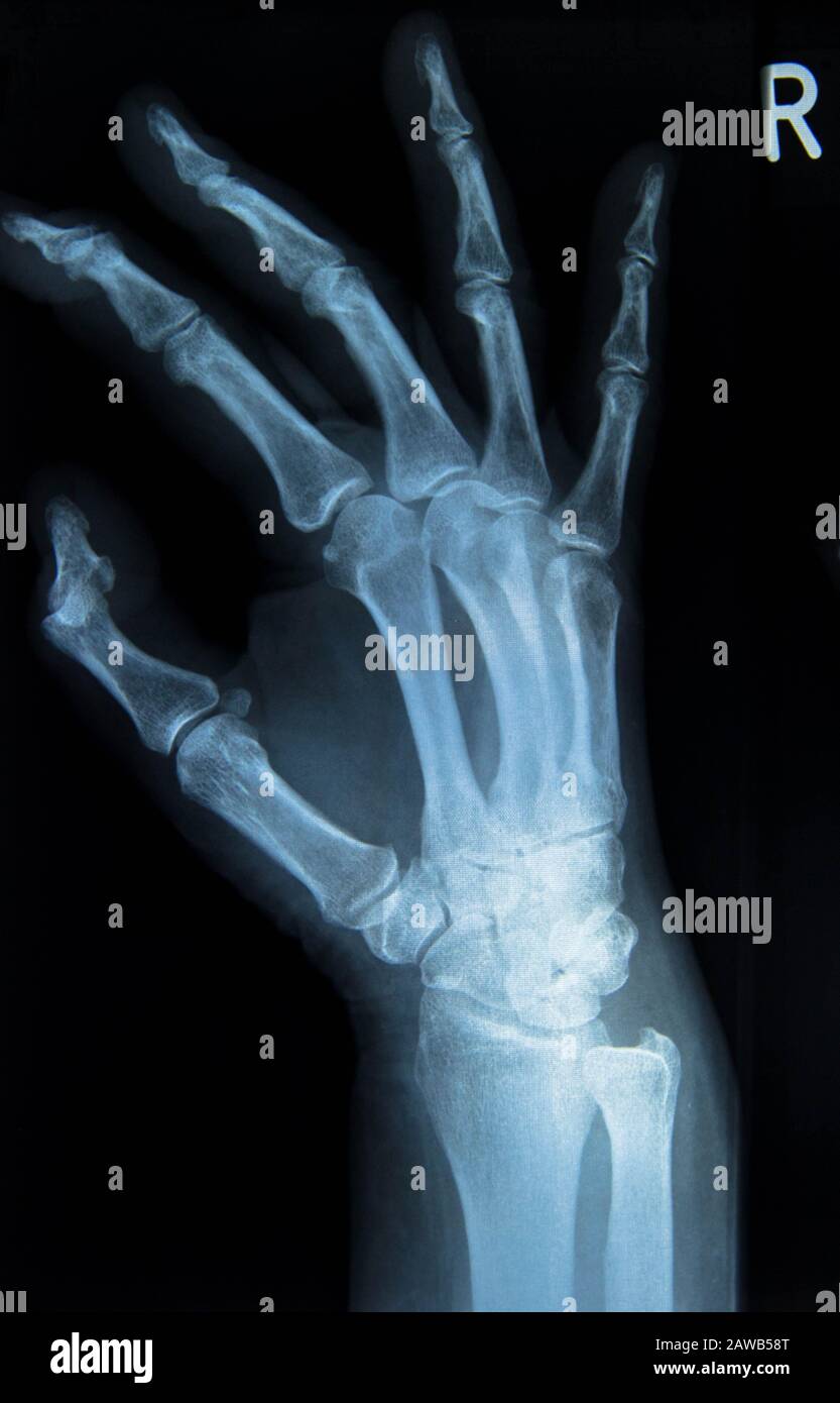 Broken Ring Finger X Ray