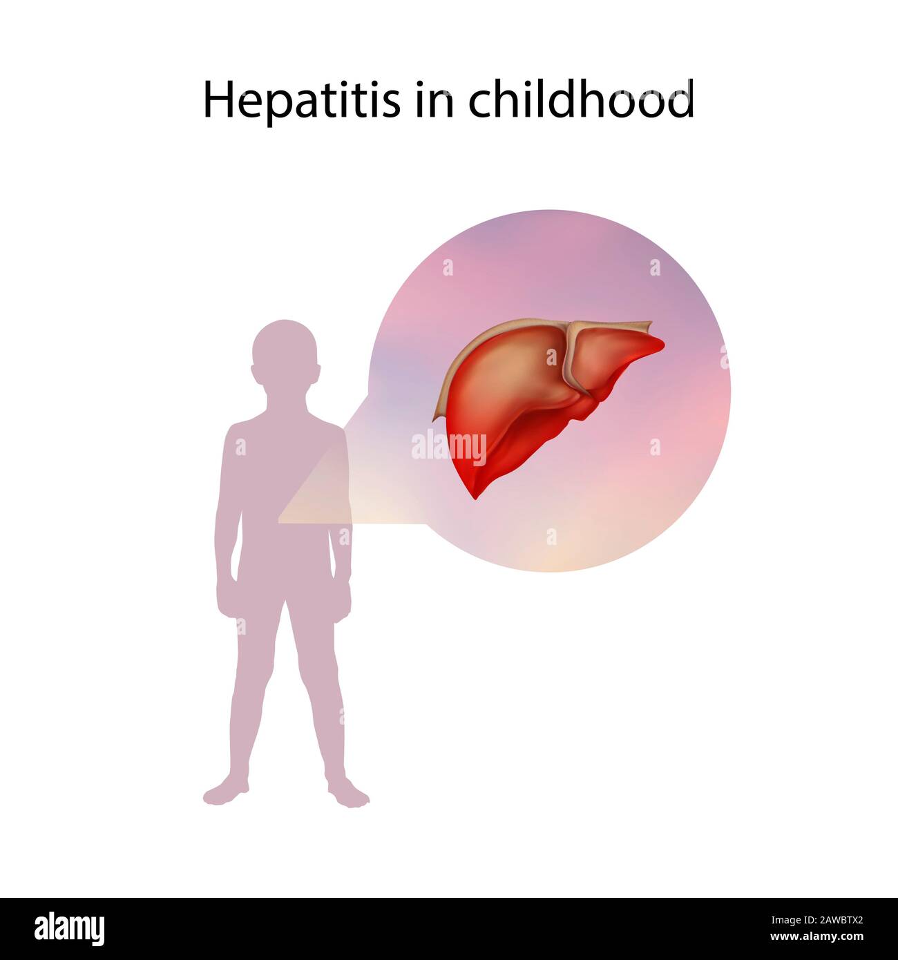 Hepatitis in childhood, illustration Stock Photo - Alamy