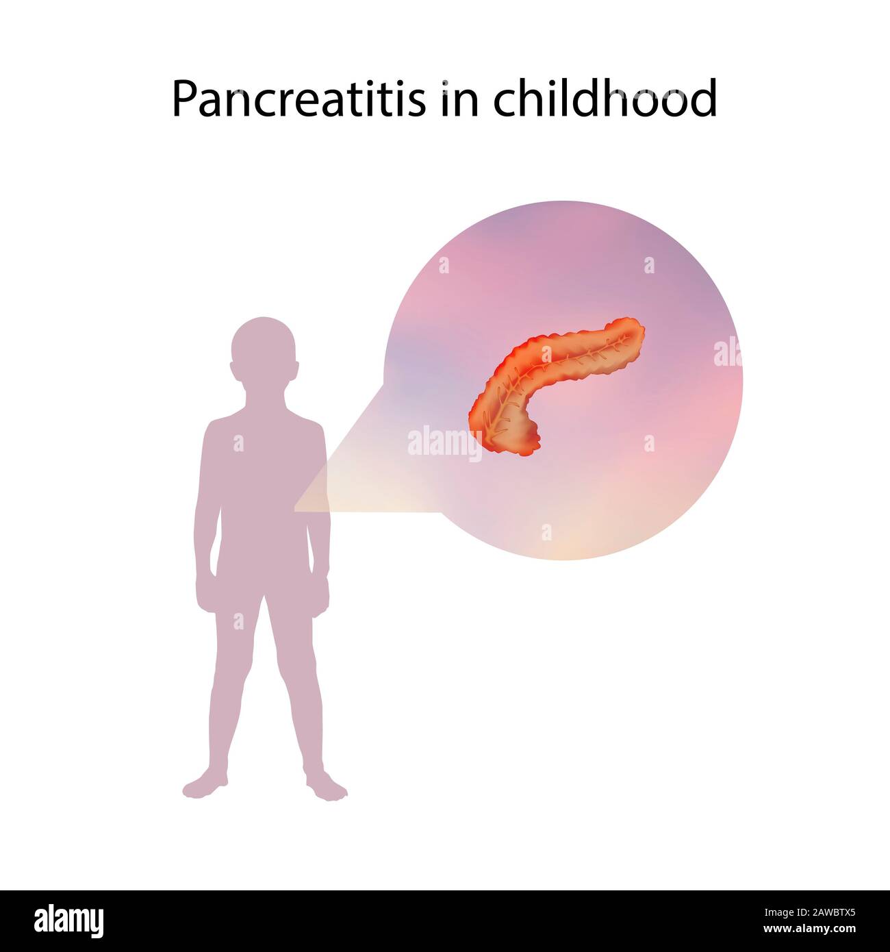 Pancreatitis in childhood, illustration Stock Photo - Alamy