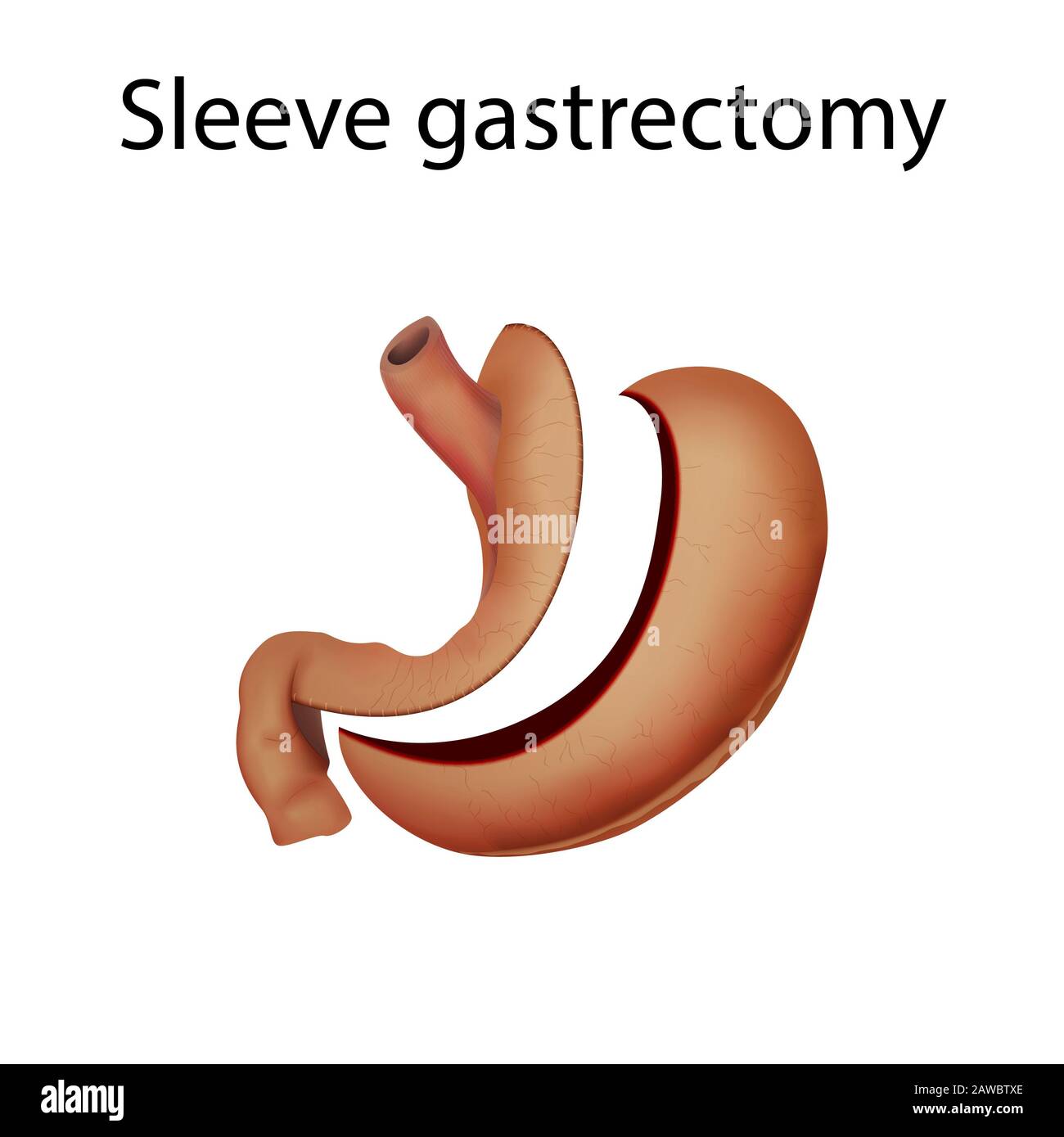 Partial gastrectomy illustration hi-res stock photography and images ...
