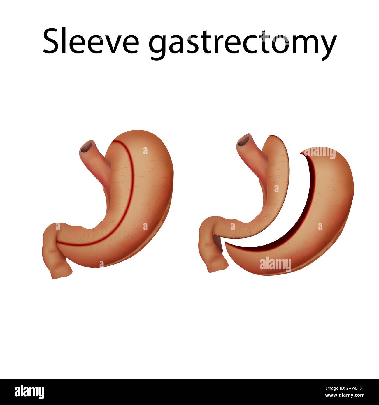 Partial gastrectomy illustration hi-res stock photography and images ...