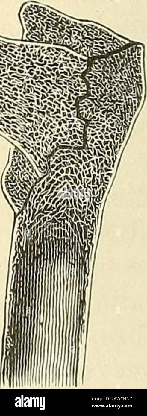 A practical treatise on fractures and dislocations . WB Fig ...