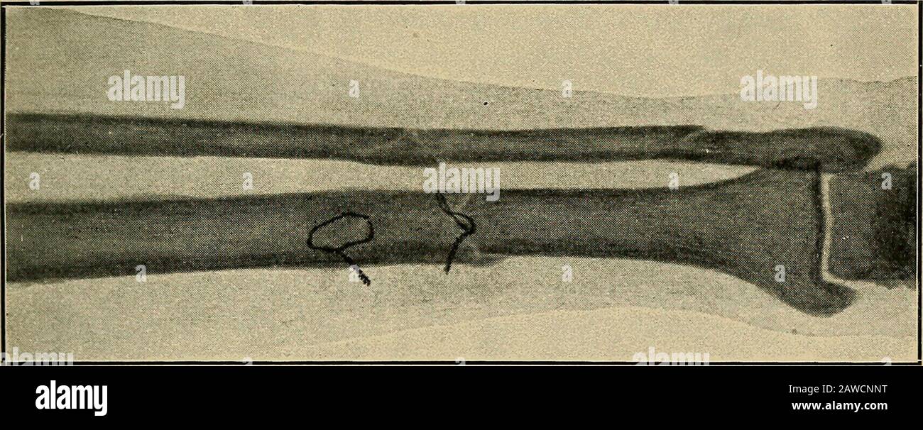 Compound bone fracture hi-res stock photography and images - Alamy