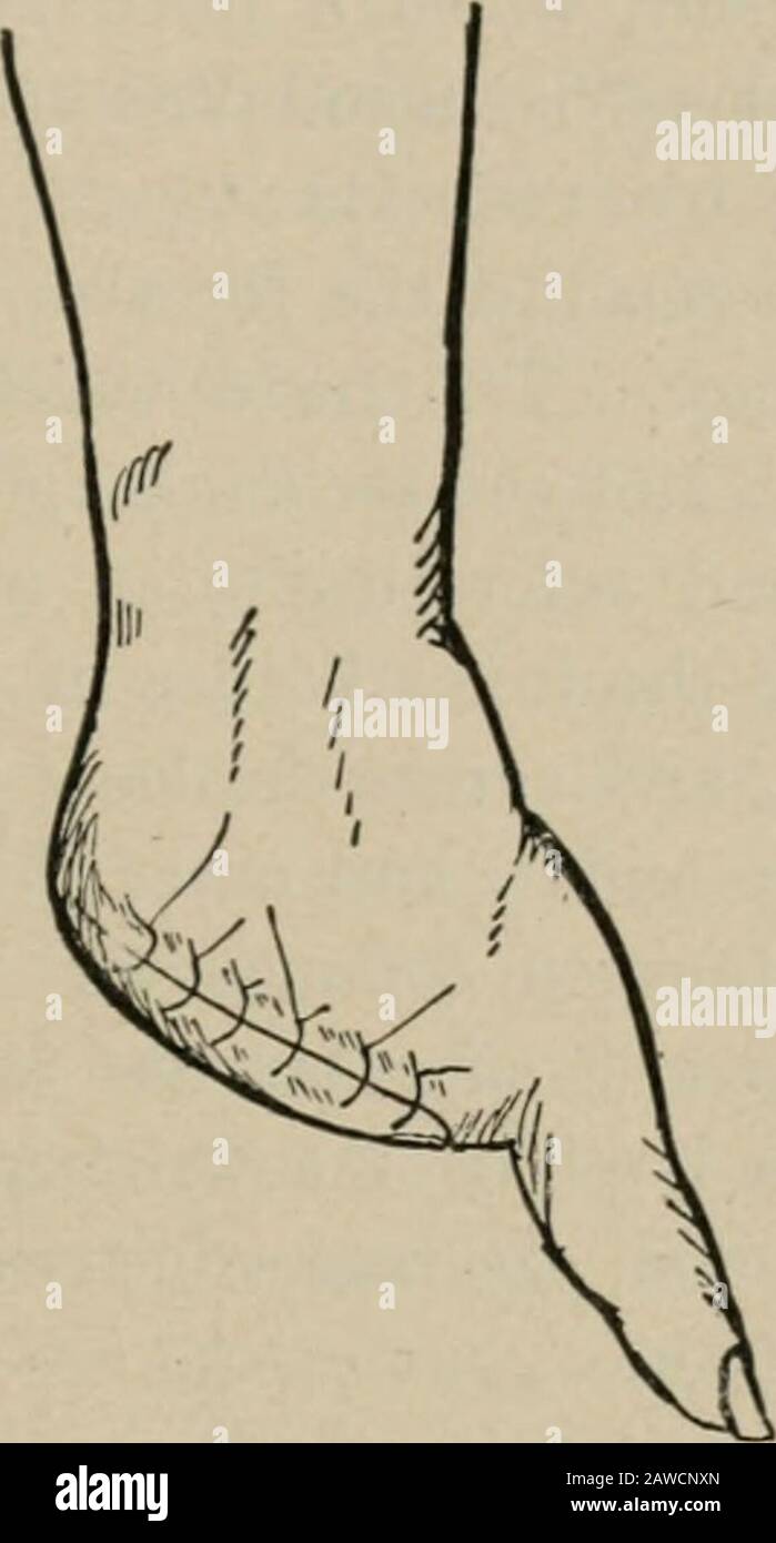 Operative surgery, for students and practitioners . ation at the wrist ...