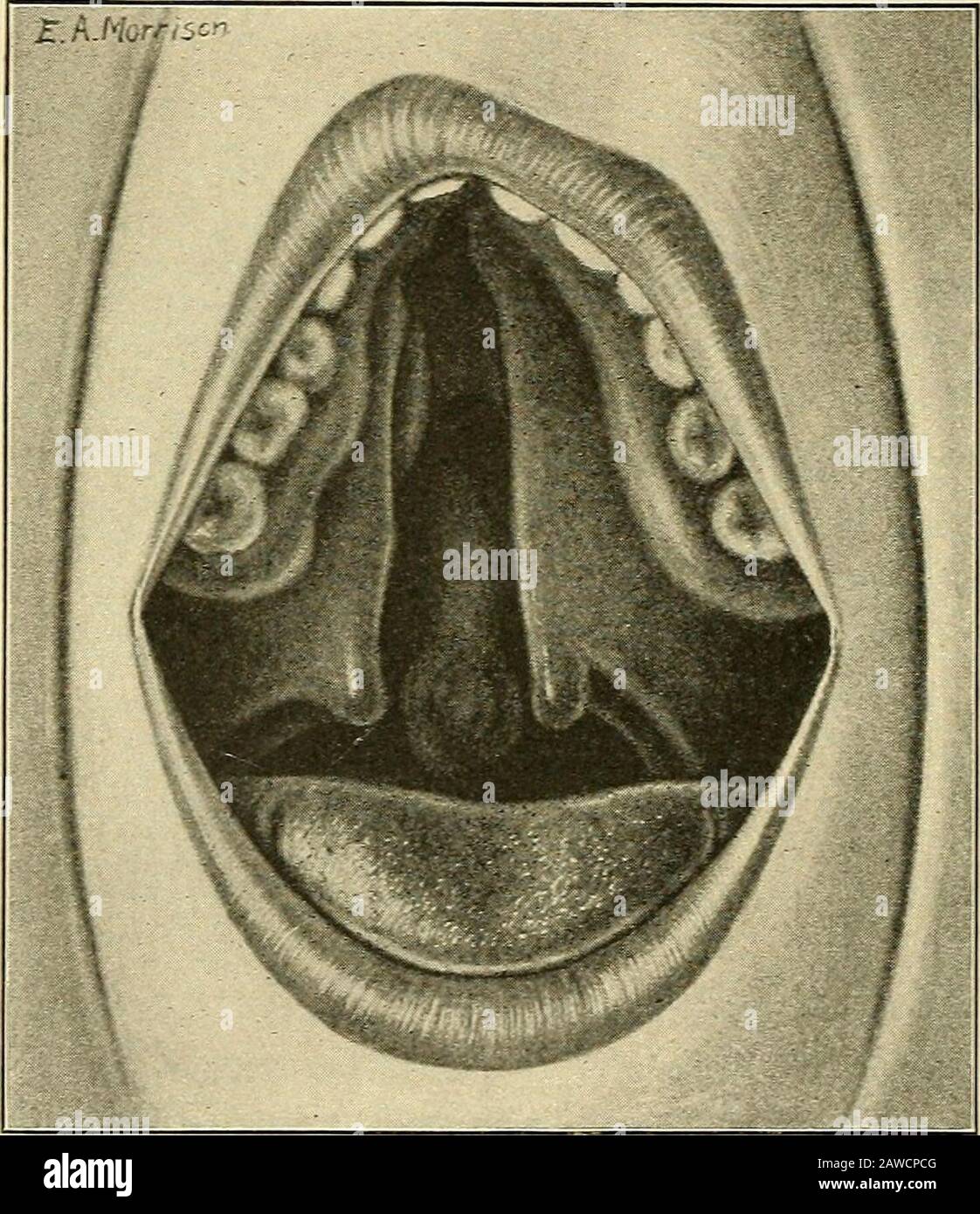 Oral clefts hi-res stock photography and images - Alamy