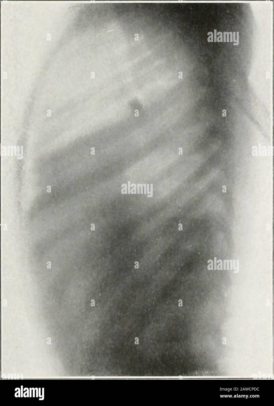 Peroral endoscopy and laryngeal surgery . Fig. 66. Curved position of ...