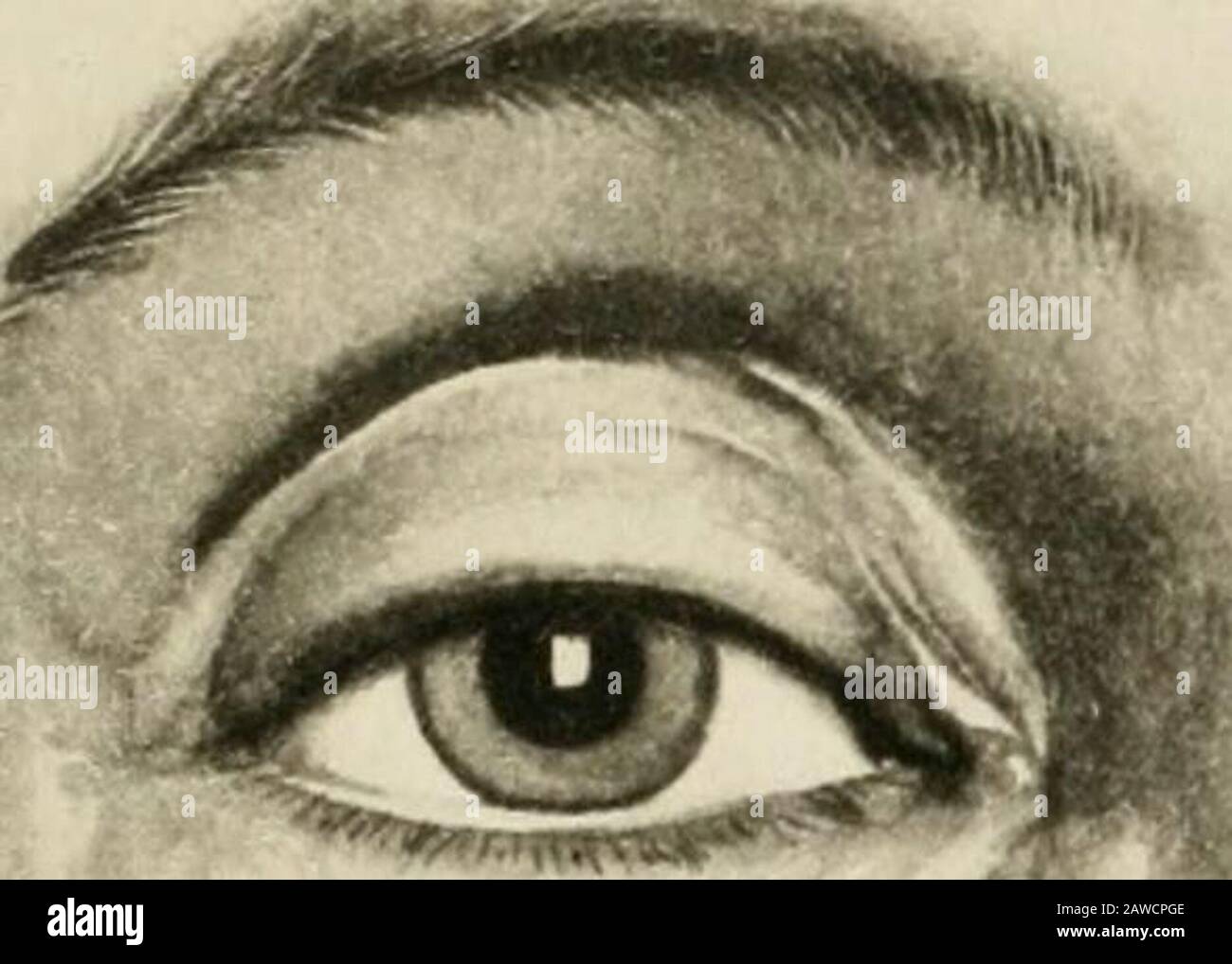 Cellulitis eye hi-res stock photography and images - Alamy