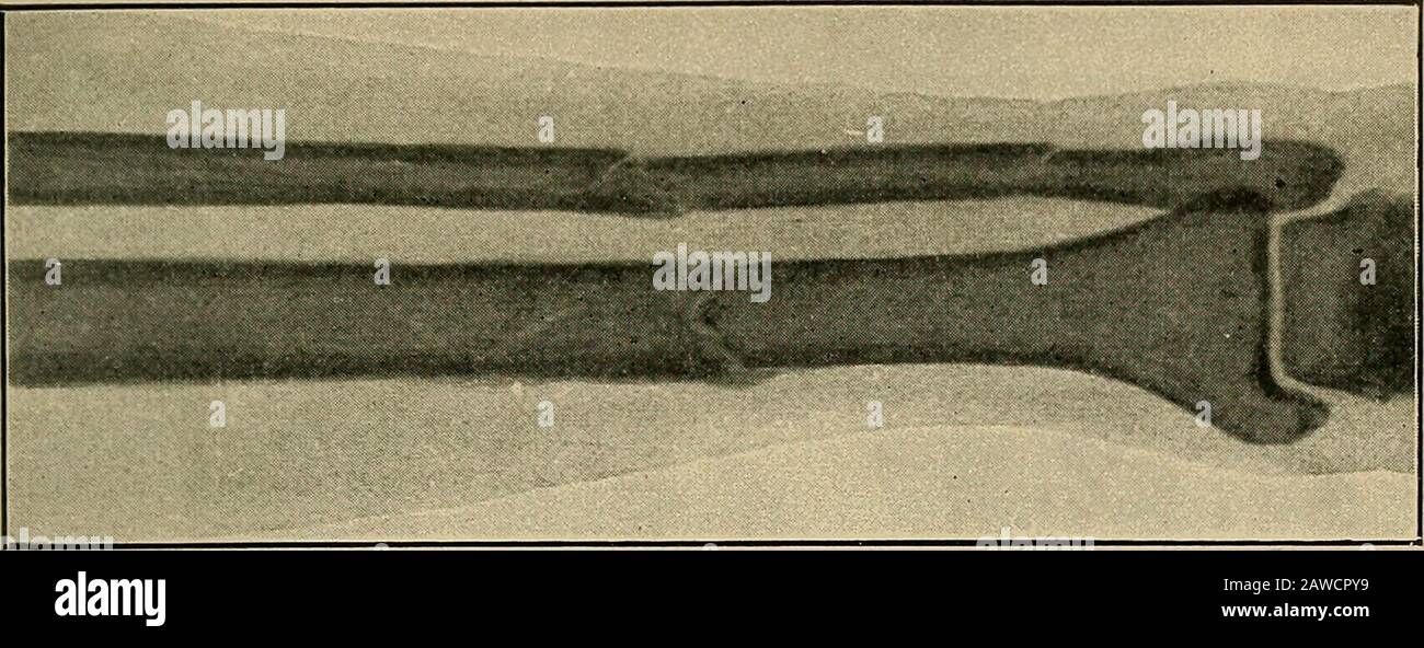 Callus formation hi-res stock photography and images - Alamy
