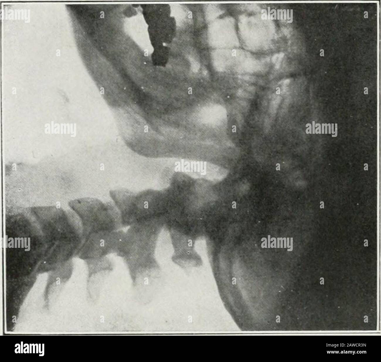 Esophagoscopy hi-res stock photography and images - Alamy