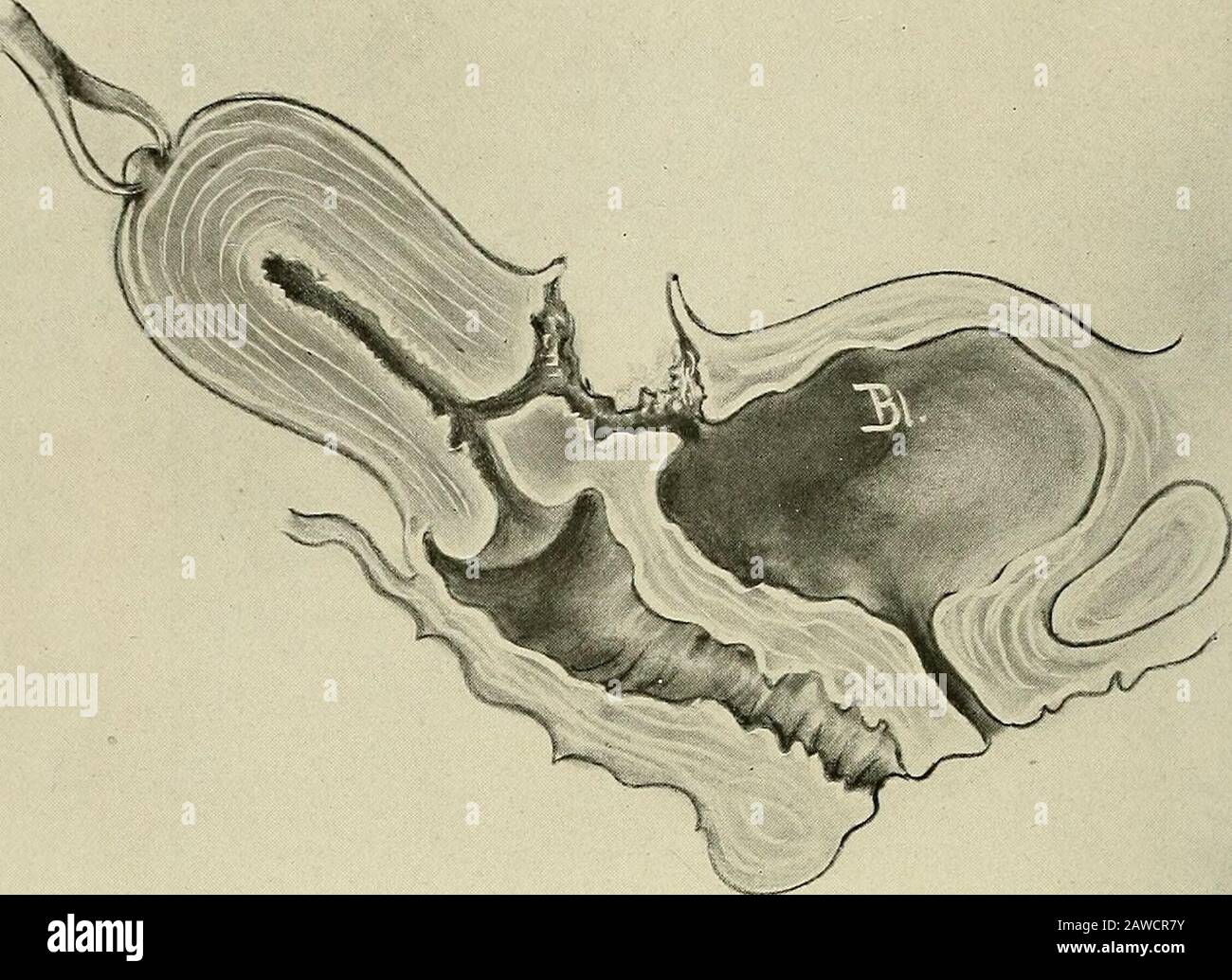 Gynecology . Fig. 261.—Uterovesical Fistula.There is a fistulous ...