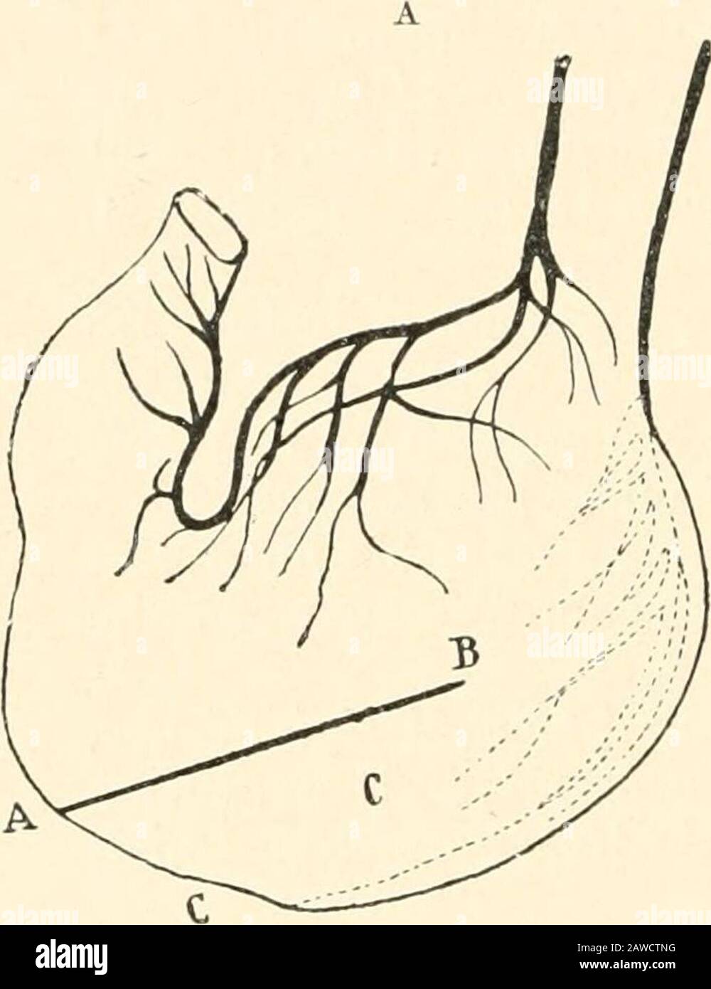 Gastric fistula hi-res stock photography and images - Alamy