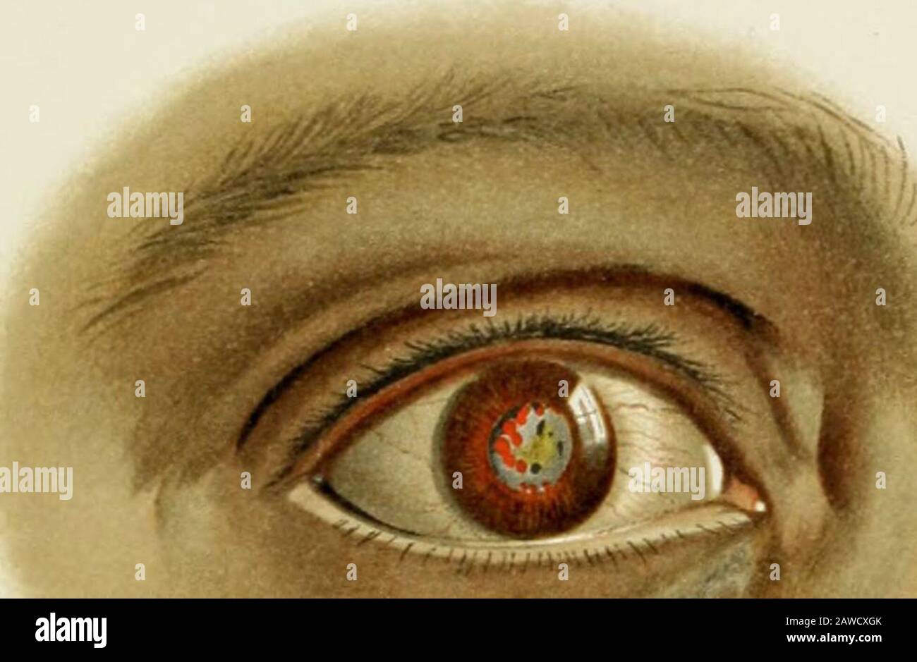 Eye injuries and their treatment . PLATE XV Stock Photo - Alamy