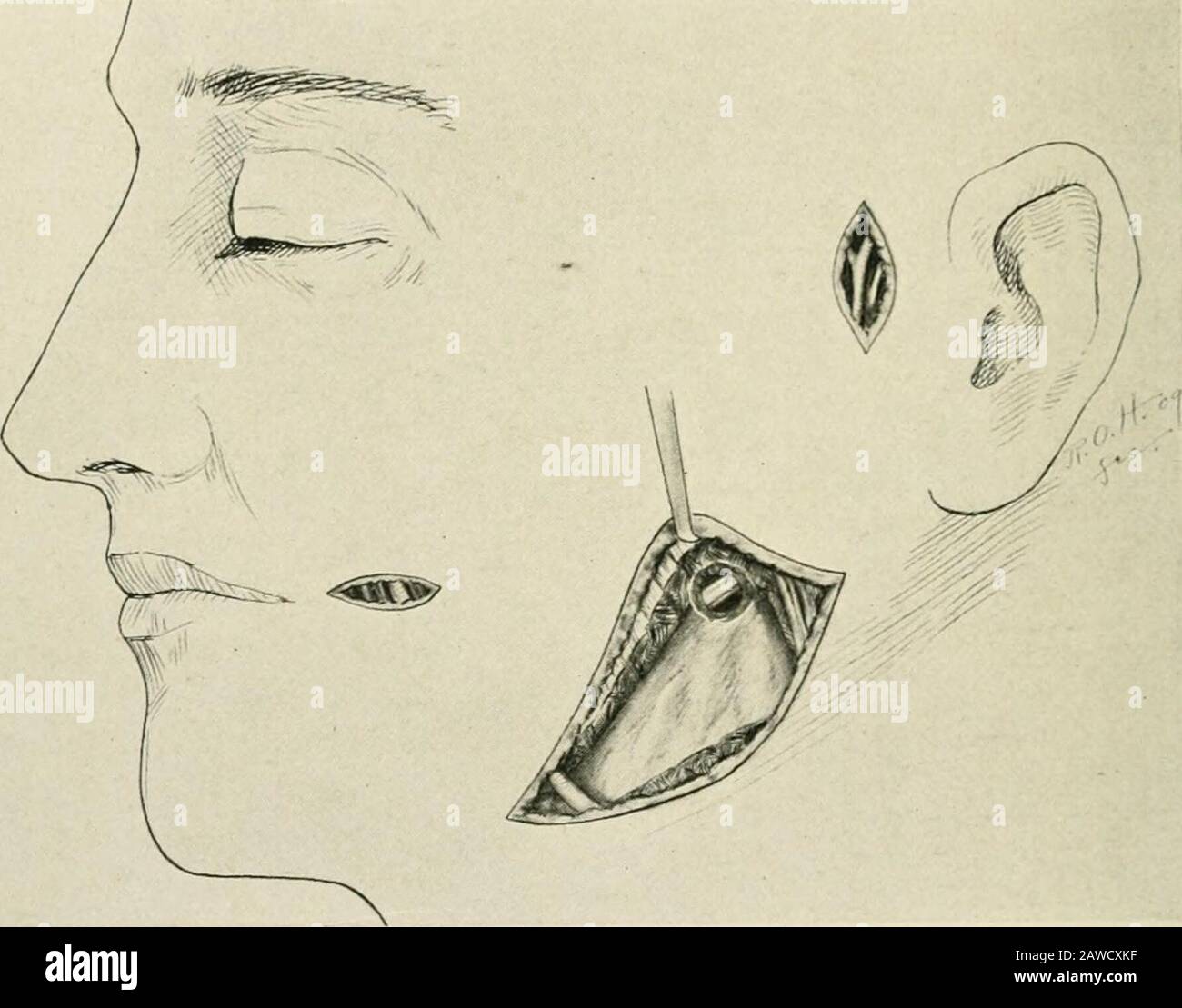 The practice of surgery . nd should notinvolve the facial nerve, Stenos ...
