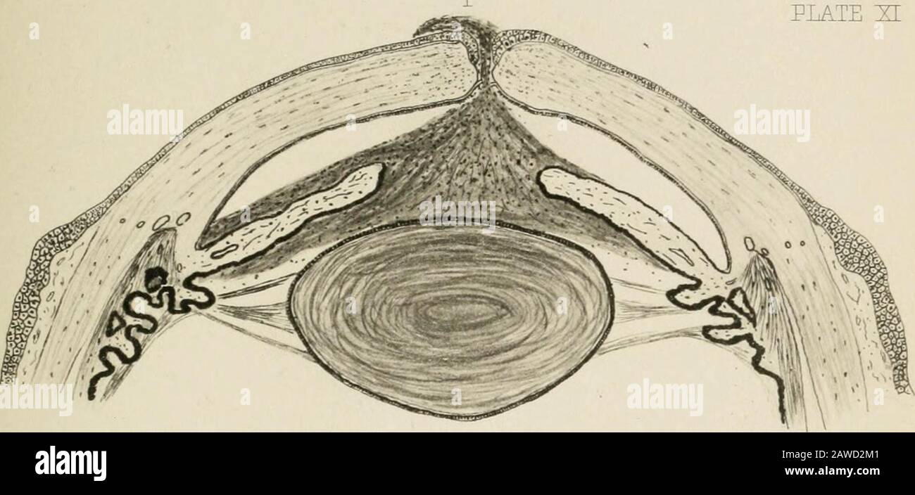 Enucleated eye hi-res stock photography and images - Alamy