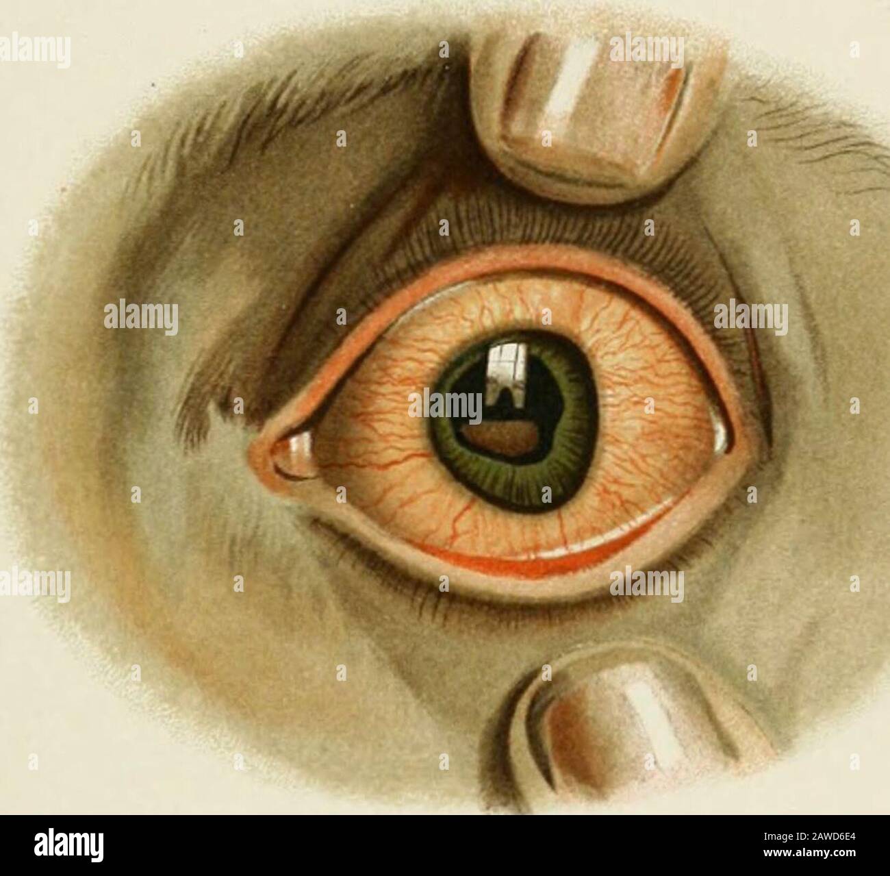 Eye injuries and their treatment Stock Photo - Alamy