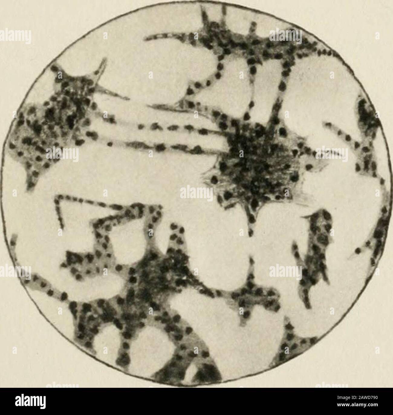 Cornea ulcer hi-res stock photography and images - Alamy