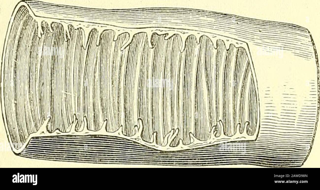 Valvulas Conniventes Obstrucción Intestinal Durante La Convalecencia