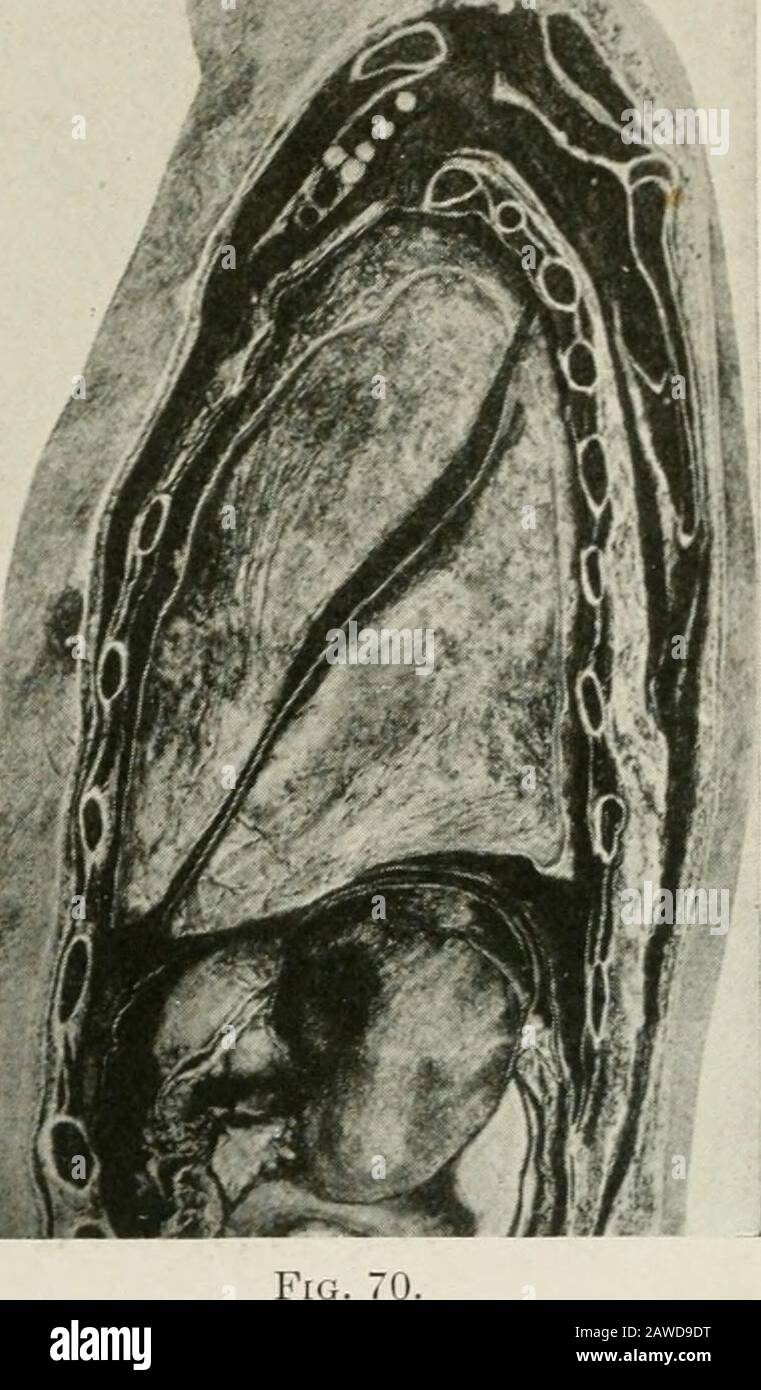 Interlobar fissure hi-res stock photography and images - Alamy