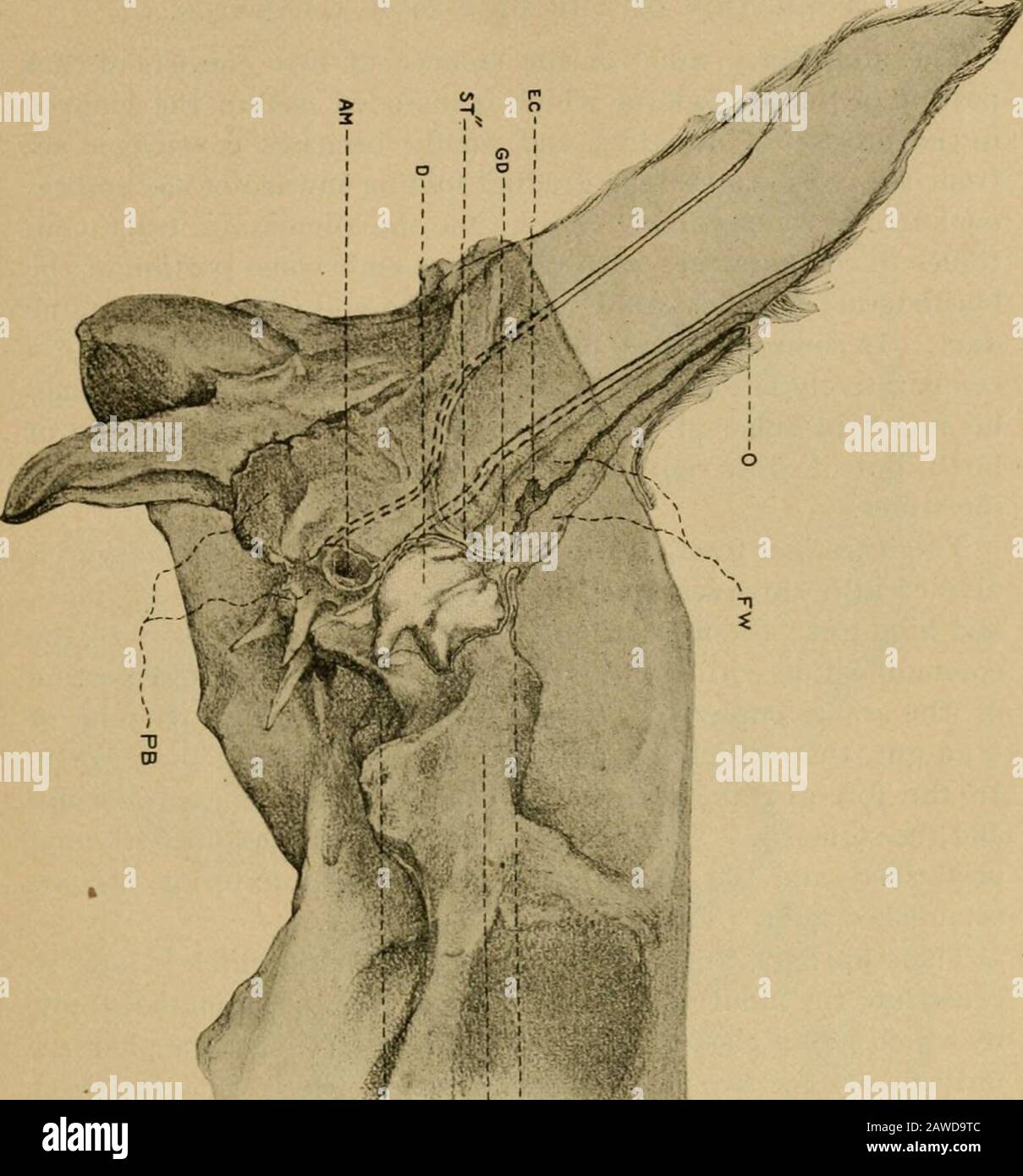 Dermoid cyst hi-res stock photography and images - Alamy