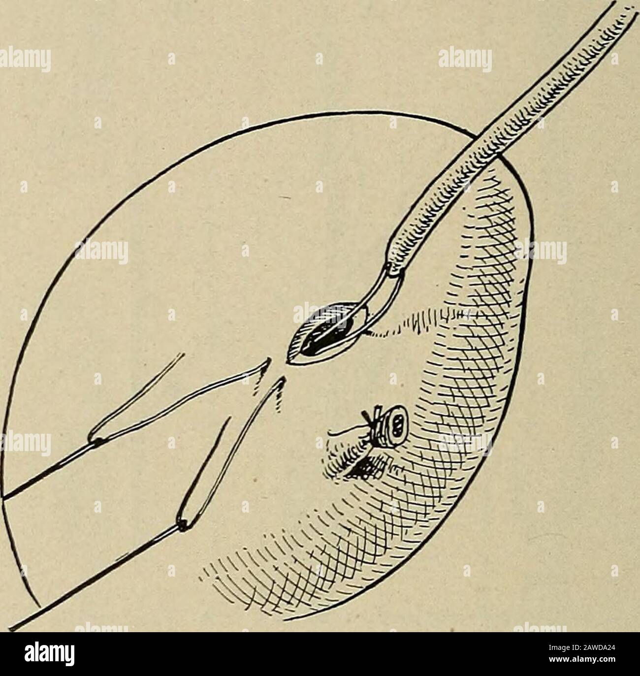 Operative surgery, for students and practitioners . d Anastomosis ...