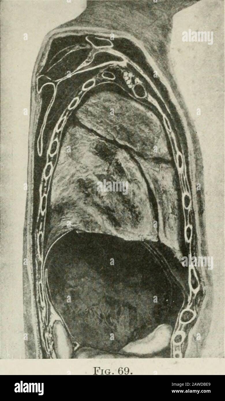 Diseases of the chest and the principles of physical diagnosis . ines ...