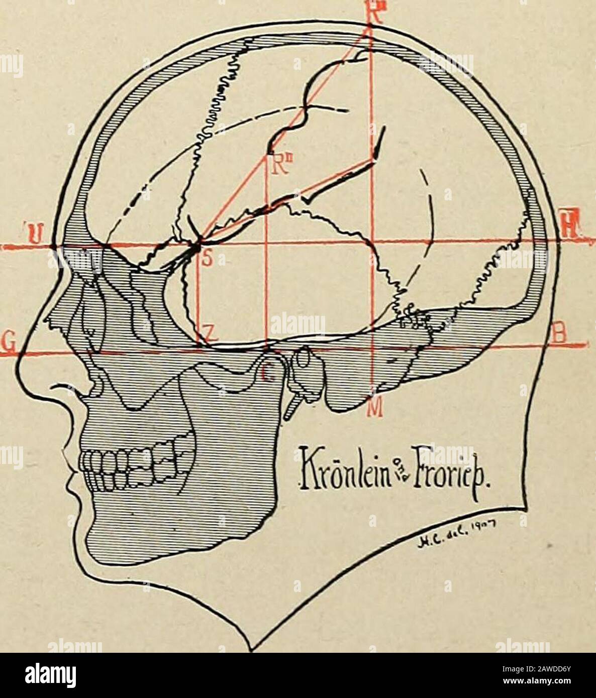 The practice of surgery . Fig. 416.âForty-five per cent, ofmedian naso ...