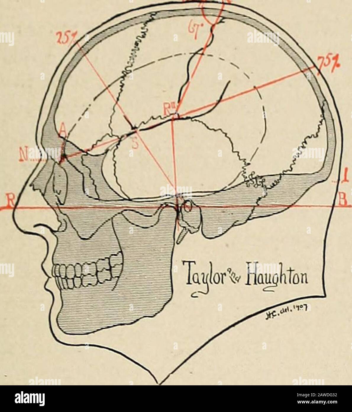 Damaged Motor Cortex