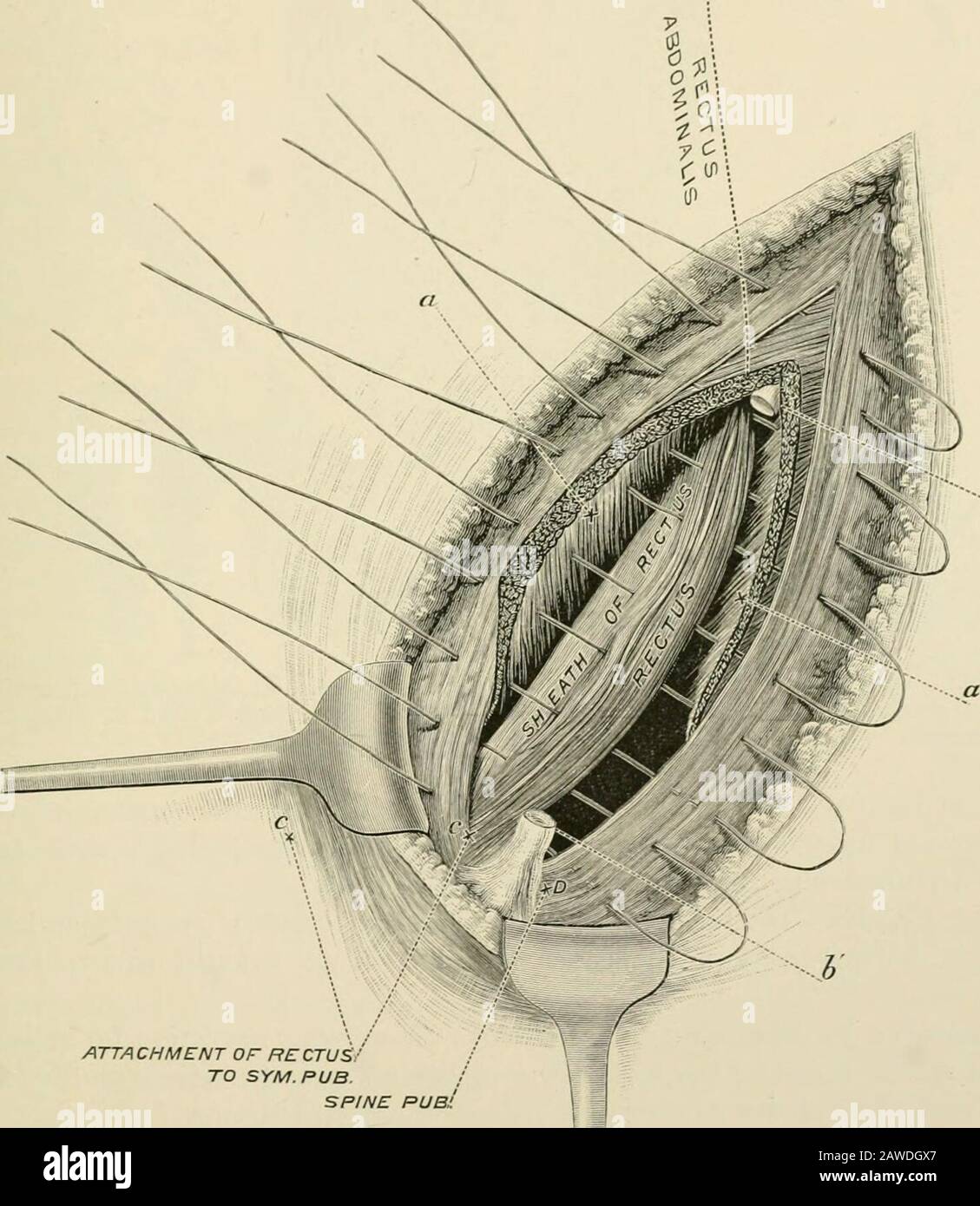 Operative surgery . h the opening (Fig. 1147); drawupward and outward ...