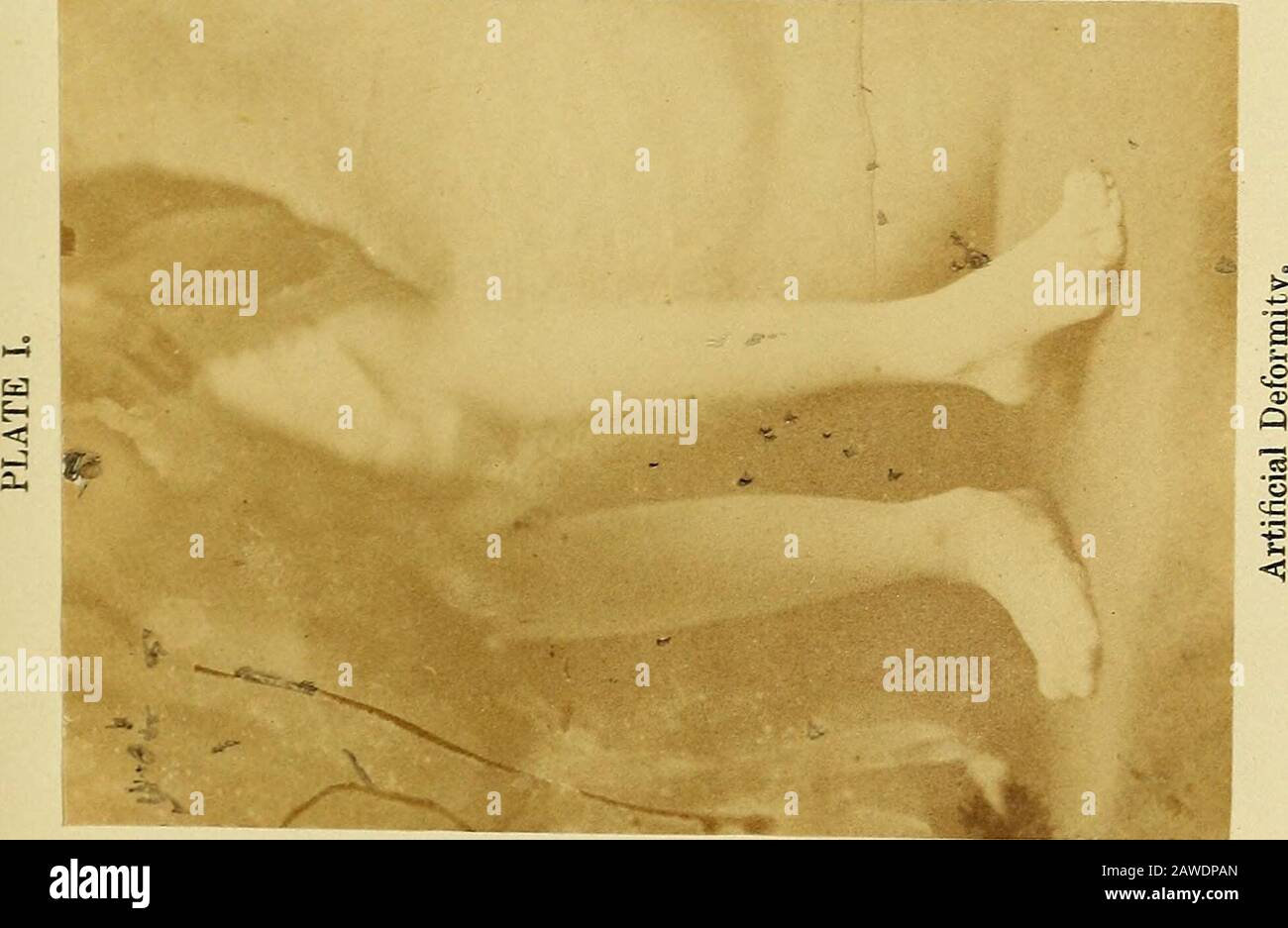 On the cure of club-foot without cutting tendons : and on certain new ...