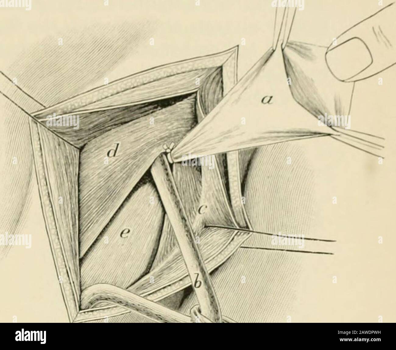 Operative surgery . Transver-salis fascia. incision without drainage ...