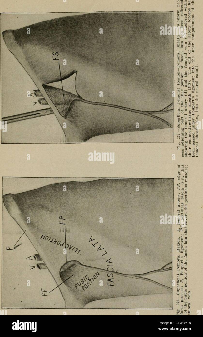 Operative surgery, for students and practitioners . The femoral sheath ...