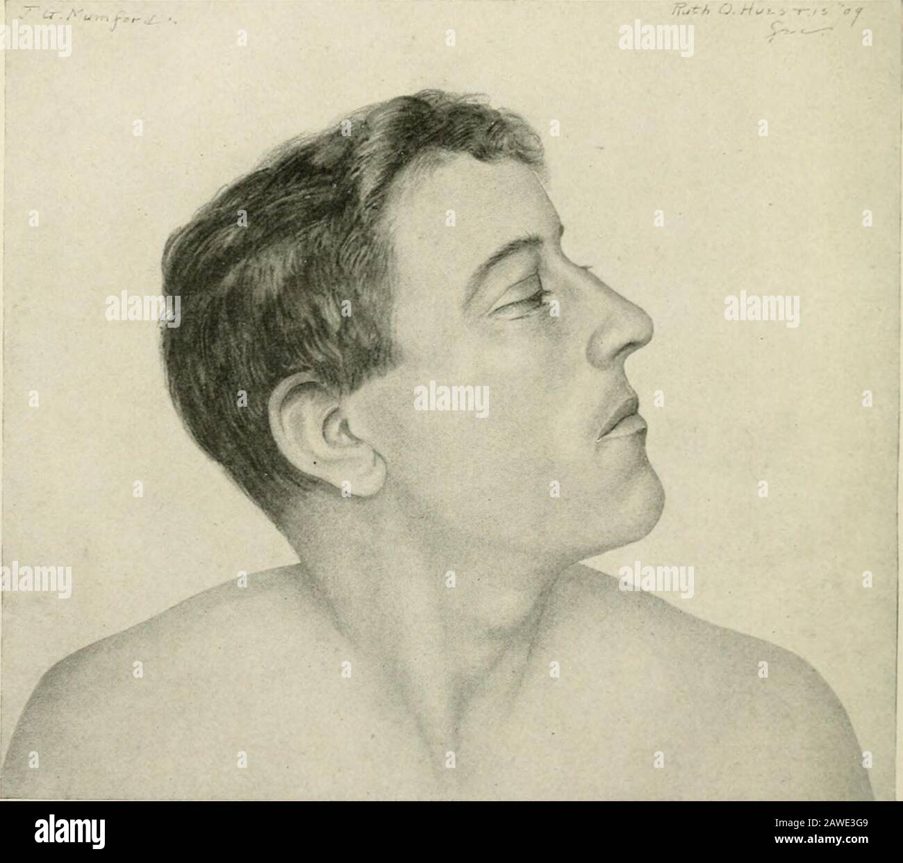The practice of surgery . spasm of muscles, throwing the head to one ...