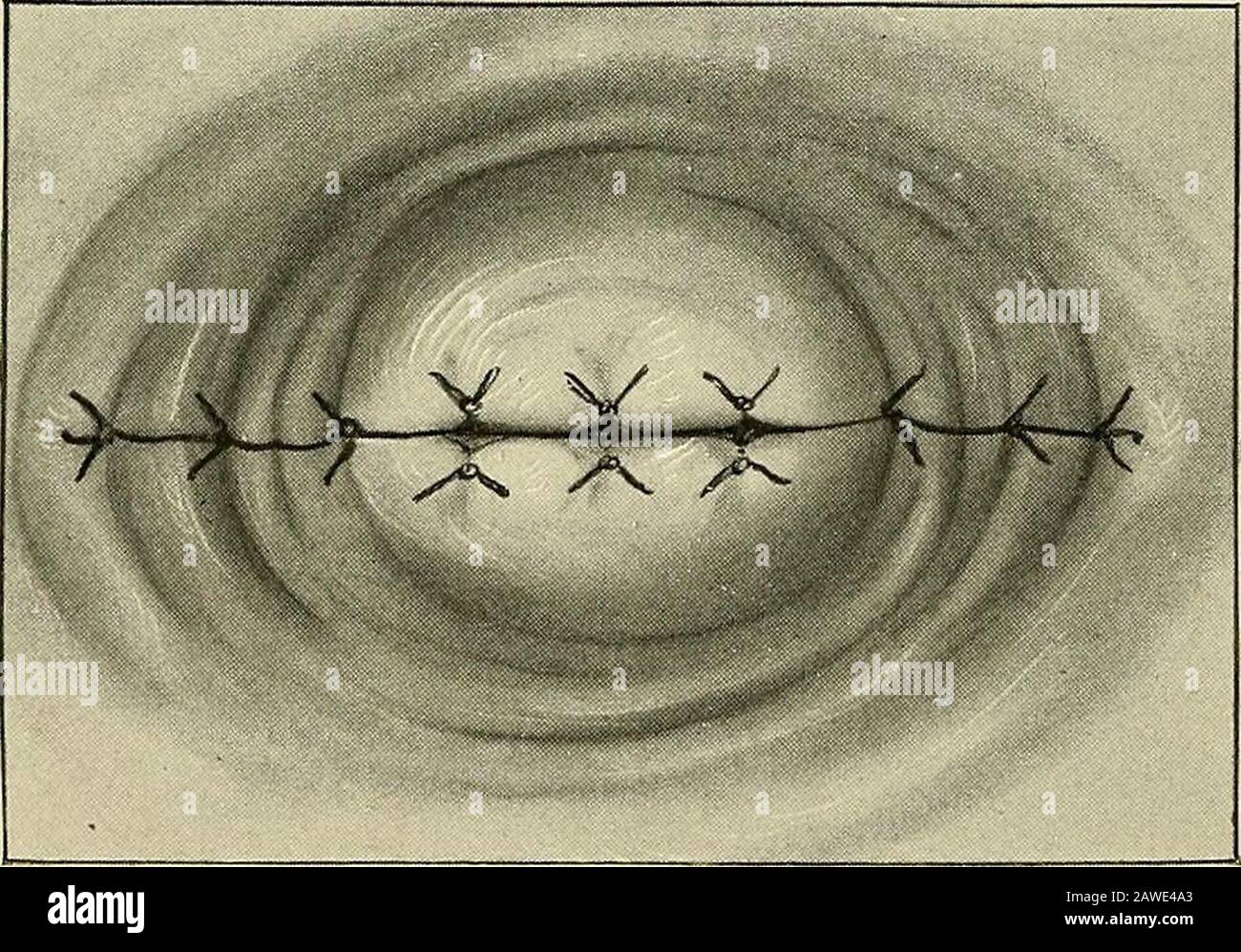 Gynecology . Fig. 214.—Amputation of the Cervix.Hegars method, showing ...
